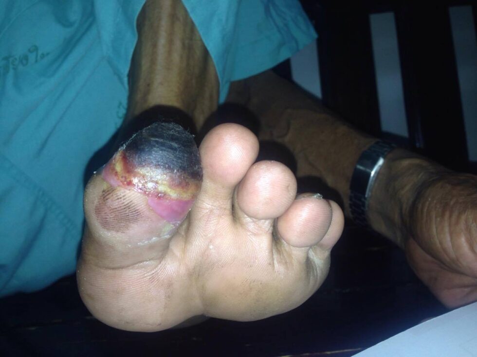 Poor blood flow to the foot - kittipanclinic